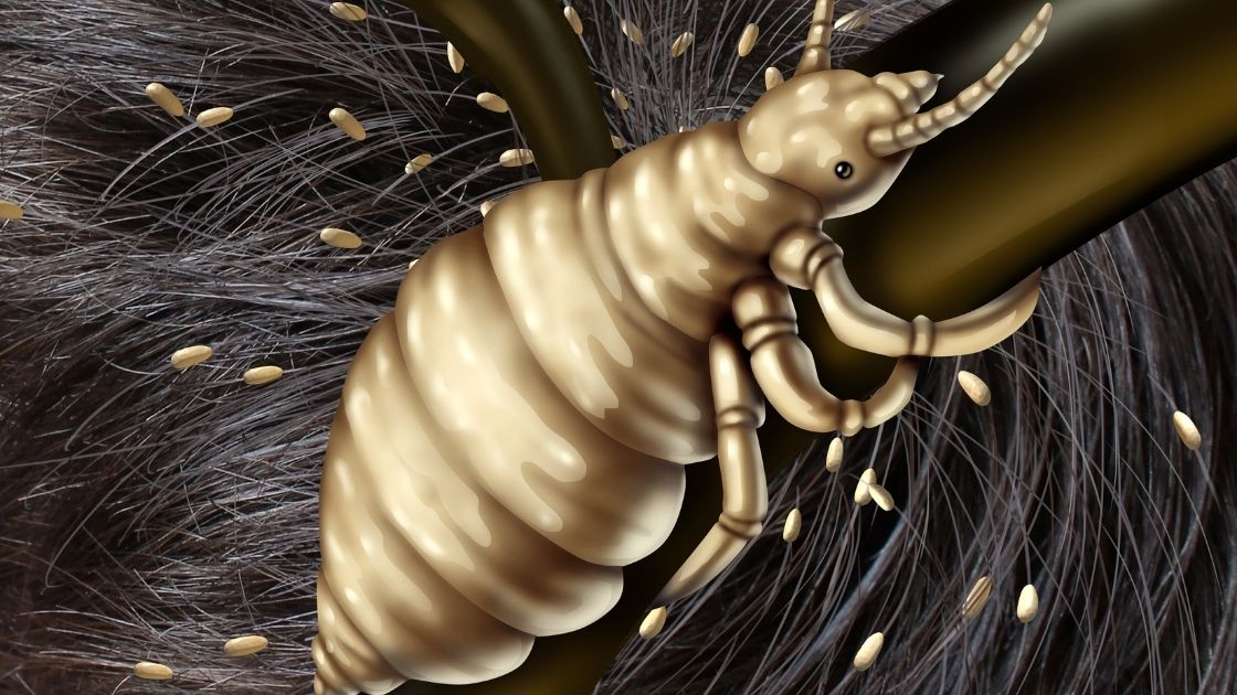 How To Get Rid Of Dandruff And Lice - The Detox Lady
