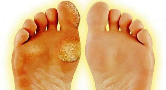 Diy Callous Remover That Works Like Magic - The Detox Lady