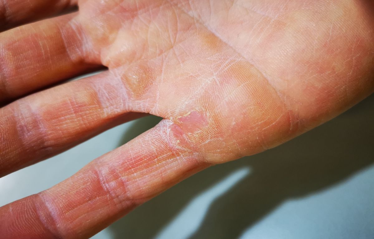 How To Get Rid Of Calluses On Hands - The Detox Lady